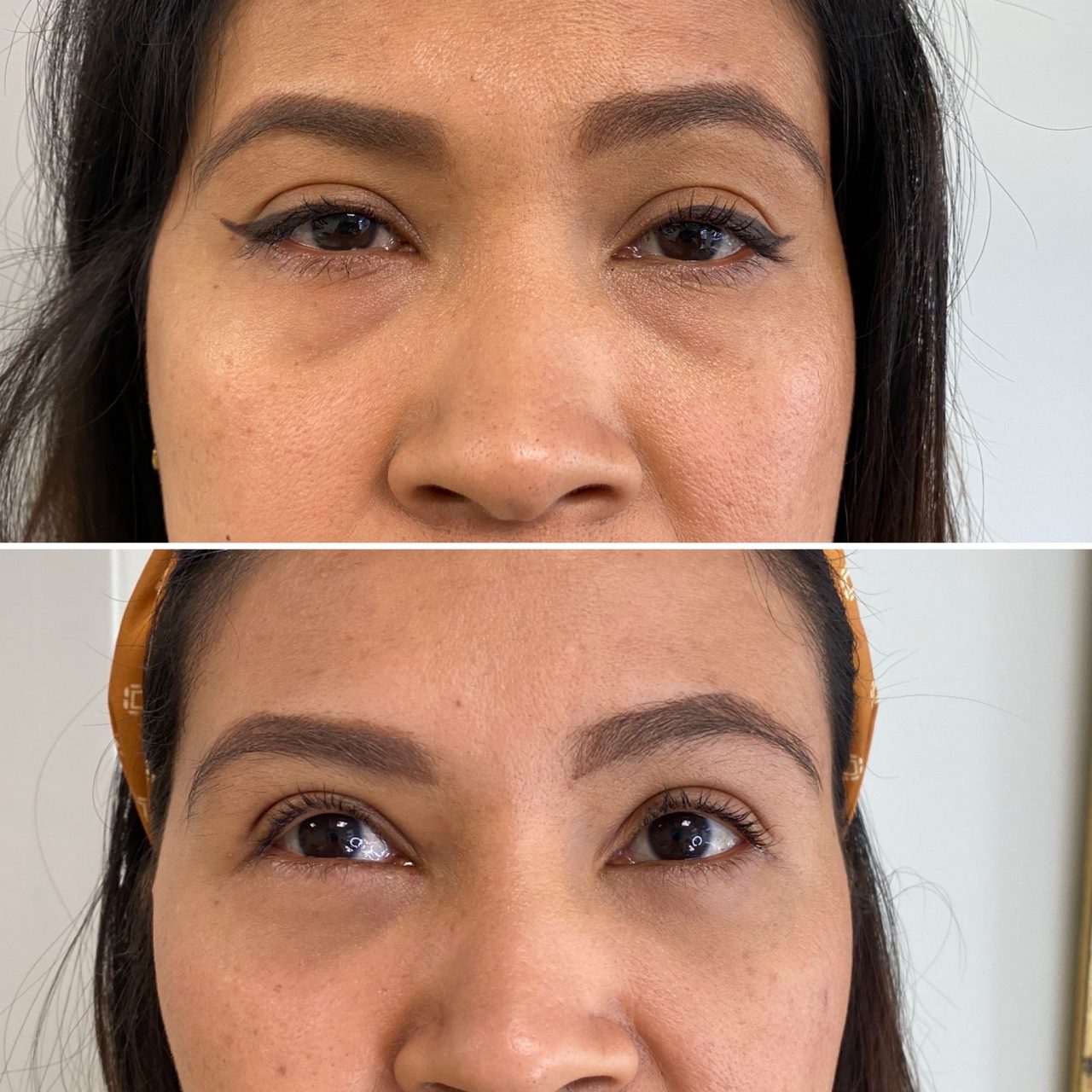 Blépharoplastie - cirugía estética de párpados- Barcelona