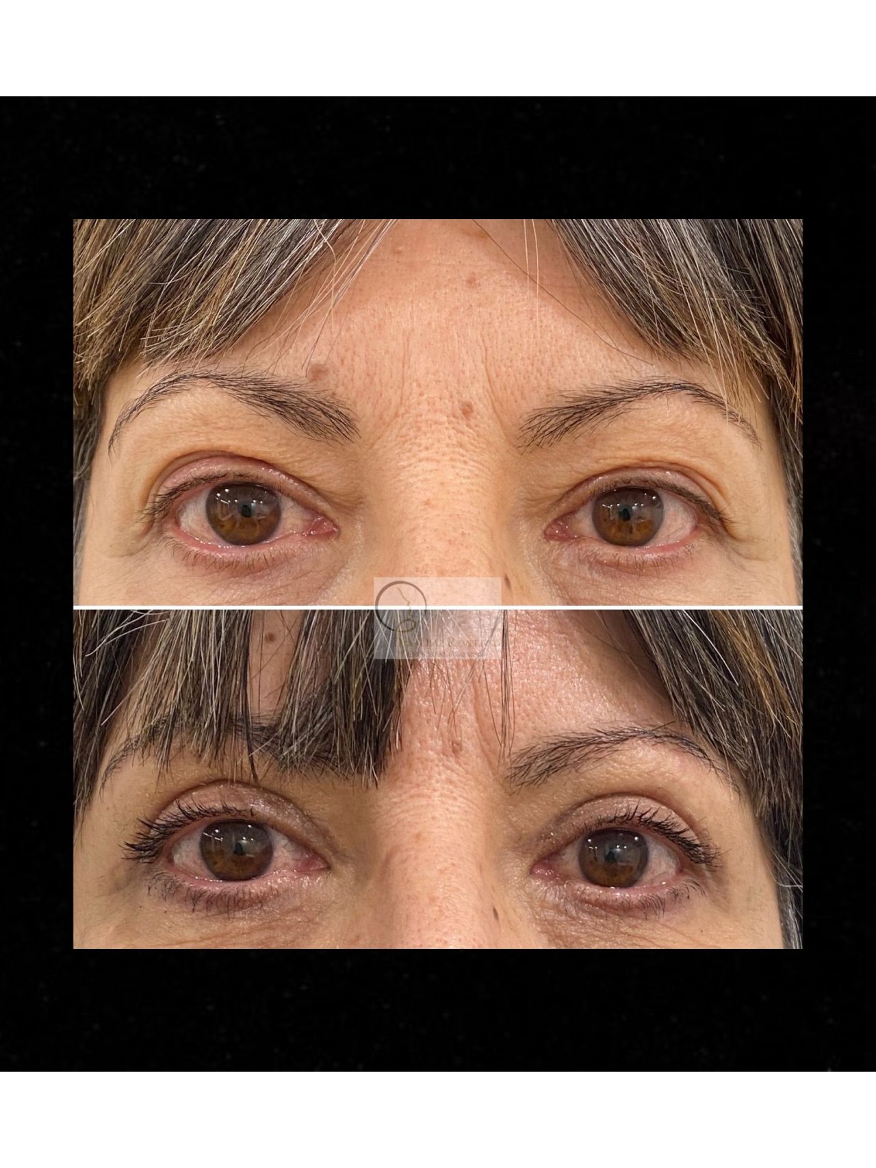 Blepharoplasty - Cosmetic eyelid surgery - Barcelona